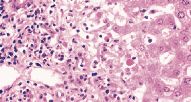 HHV-6 reactivation and poor CD4+ cell reconstitution predict pediatric ...